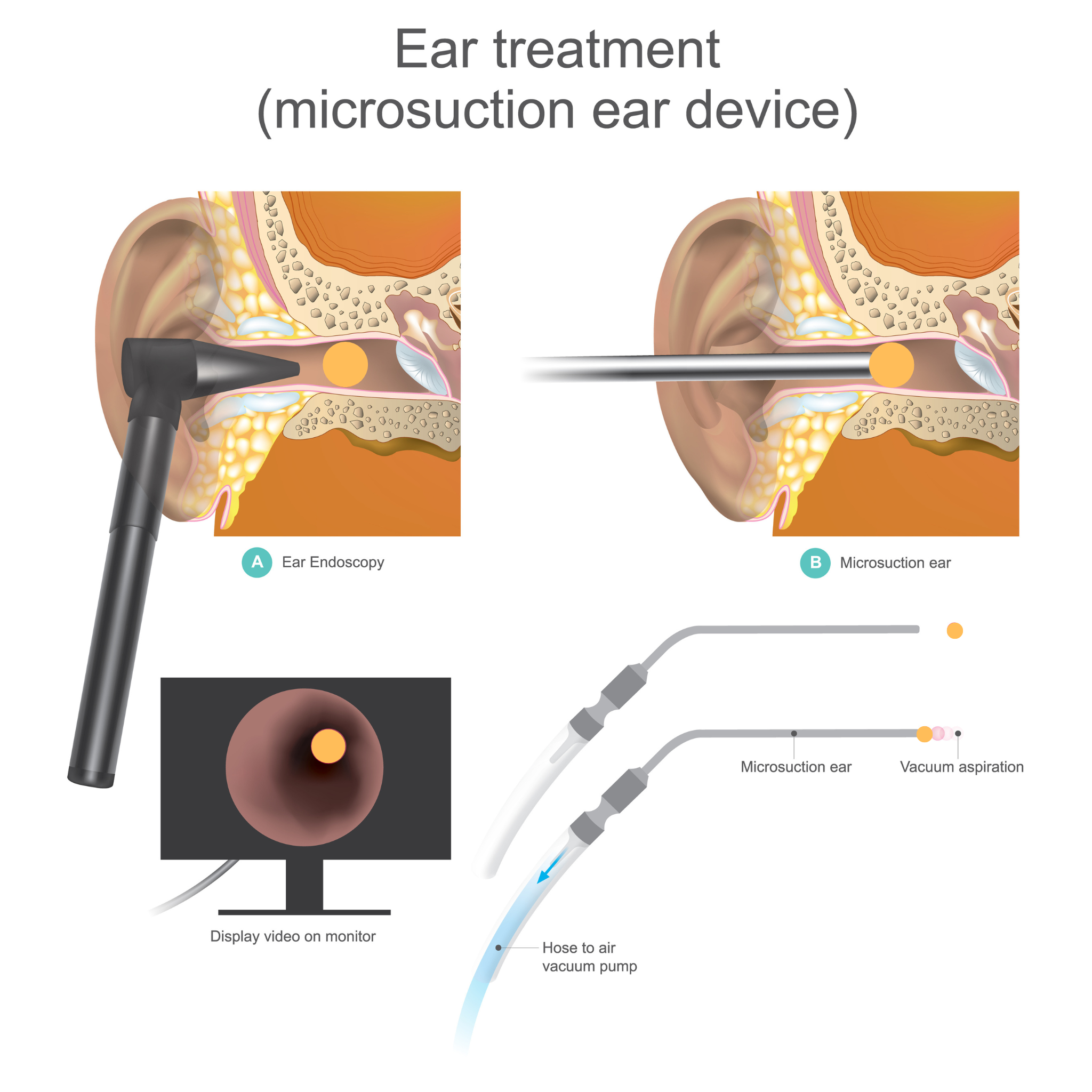 Olive Oil for Earwax Removal: The Best Ear Drops for Clear Ears ...